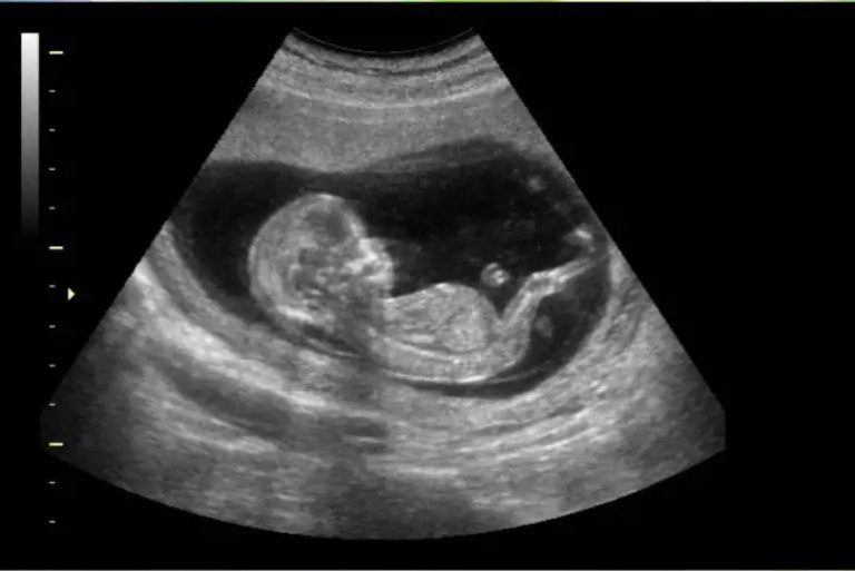 Tipos de Ultrasonidos | Clinica Materno Fetal Dr Reyes
